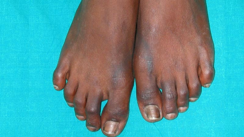 Addisson disease - MedicSpark.com