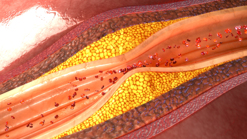 Atherosclerosis: Do you know the symptoms or causes, risks, prevention ...