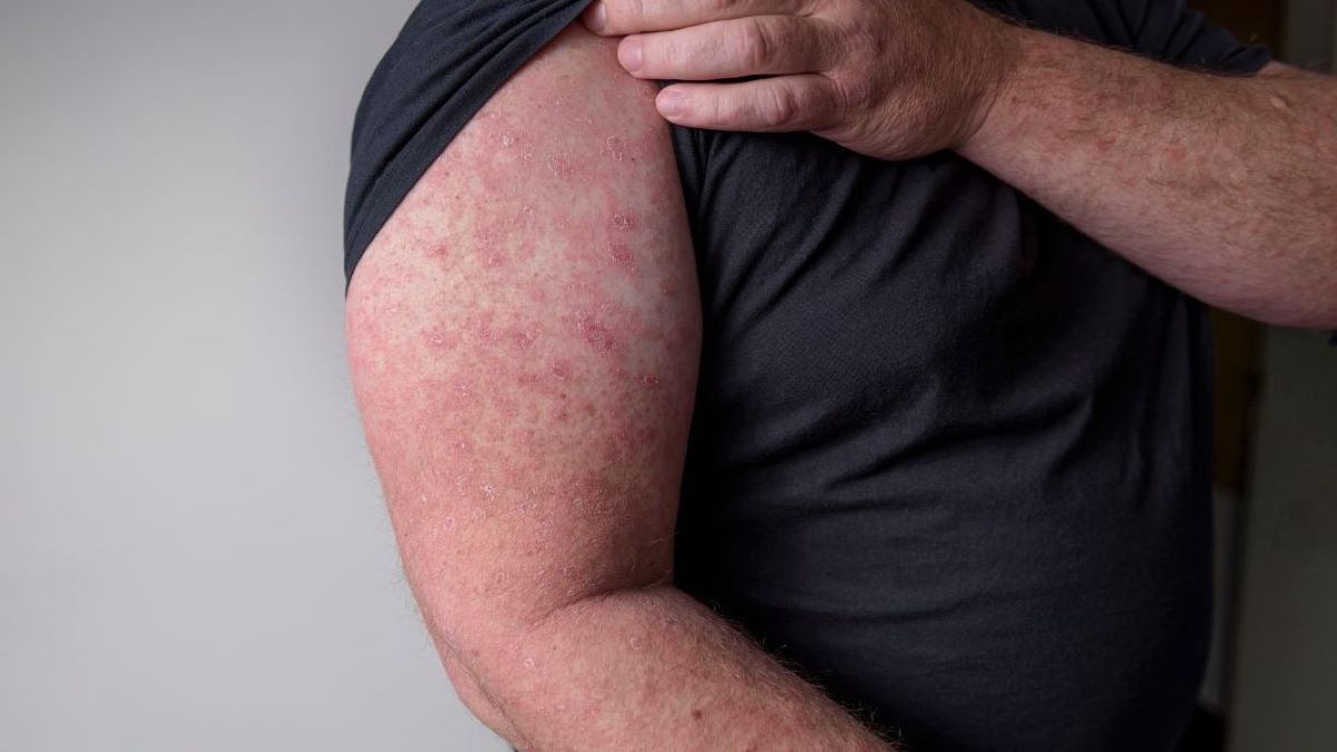 Erysipelas: Why is rose an infectious disease, is it transmissible ...