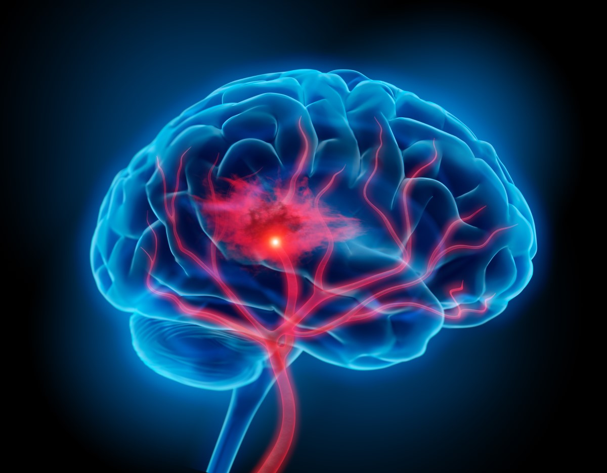 Bleeding in the brain: why does it occur and what are its symptoms ...