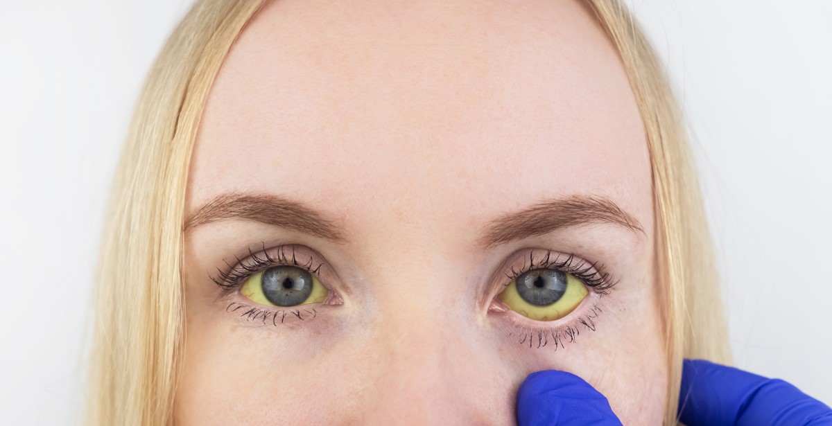 Jaundice: Causes, Symptoms, Treatment - MedicSpark.com