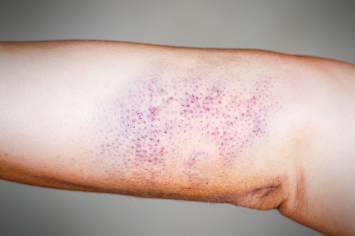 Petechiae as a manifestation of insignificant to fatal diseases ...