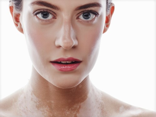 Why do white patches appear on the skin? - symptom - MedicSpark.com