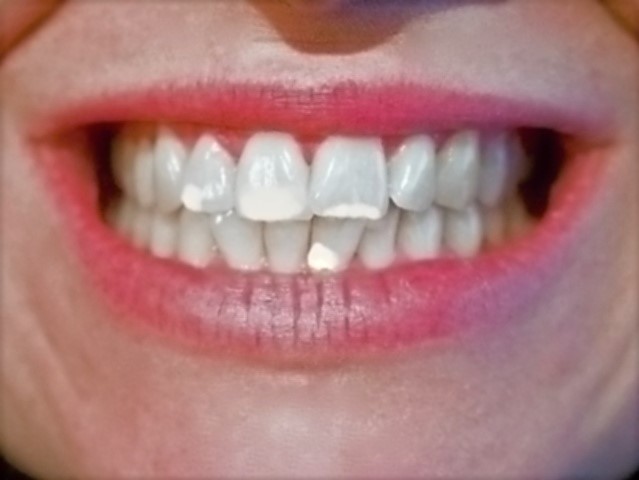 White Spots on Teeth: Causes, Symptoms, Treatment - symptom ...