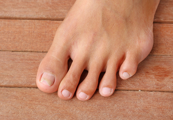 Deformed nails - what are their most common causes? - symptom ...