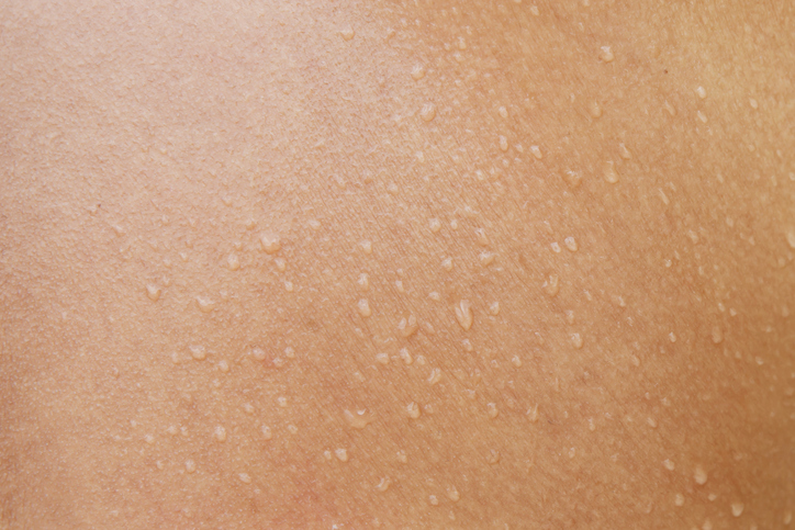 Wet skin due to inflammation, dermatitis or eczema? Know the causes ...