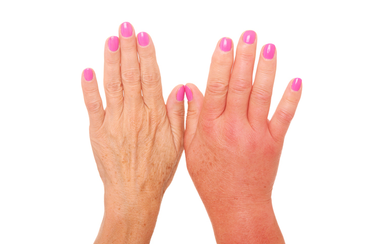 Swollen fingers: why do our fingers swell, what disease does it mean ...