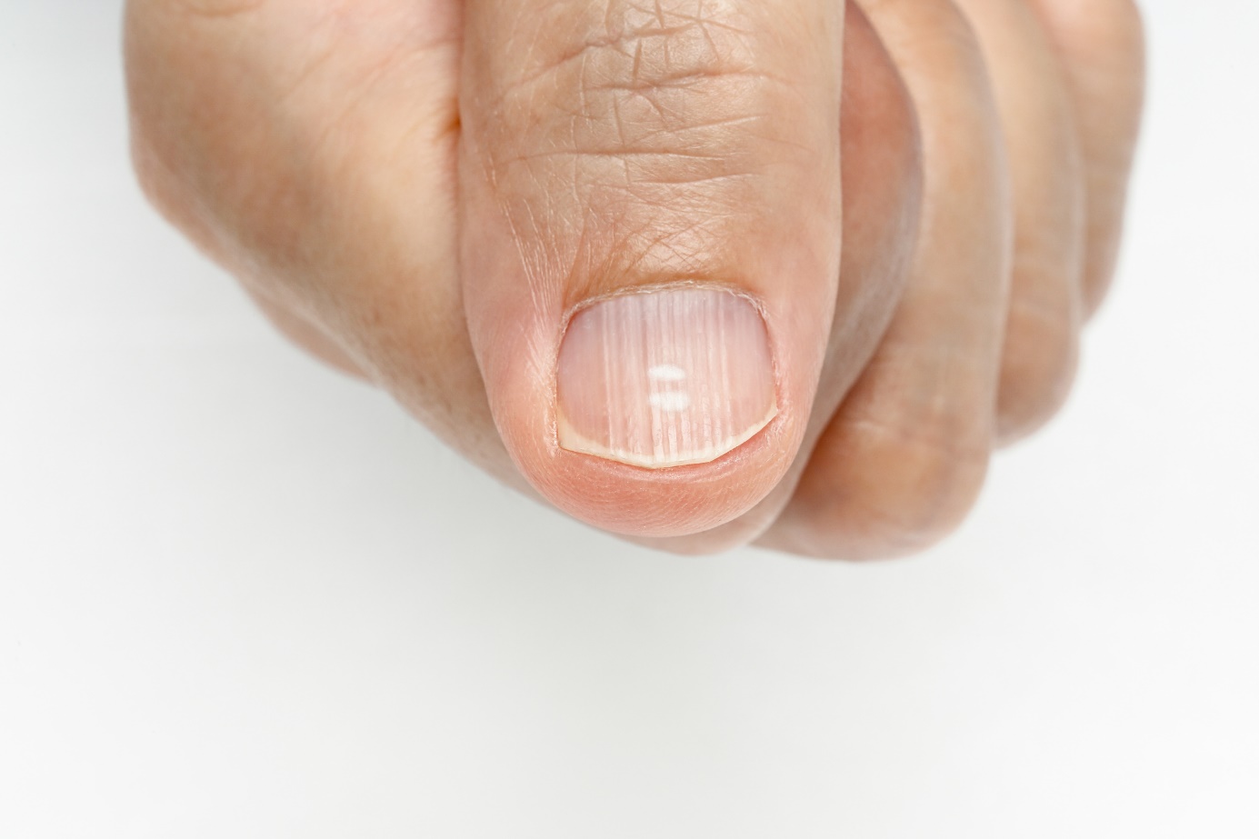 Unaesthetic nail lines: why do they occur? Can they be prevented ...