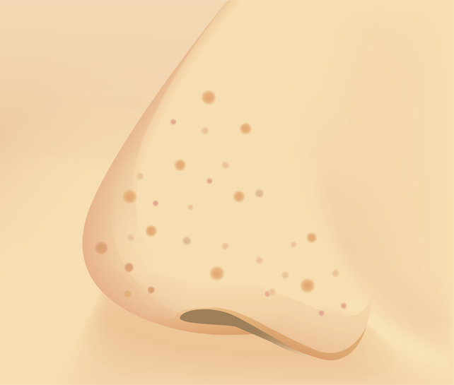 Uhry: What causes the black dots? Can they be pushed out? - symptom ...