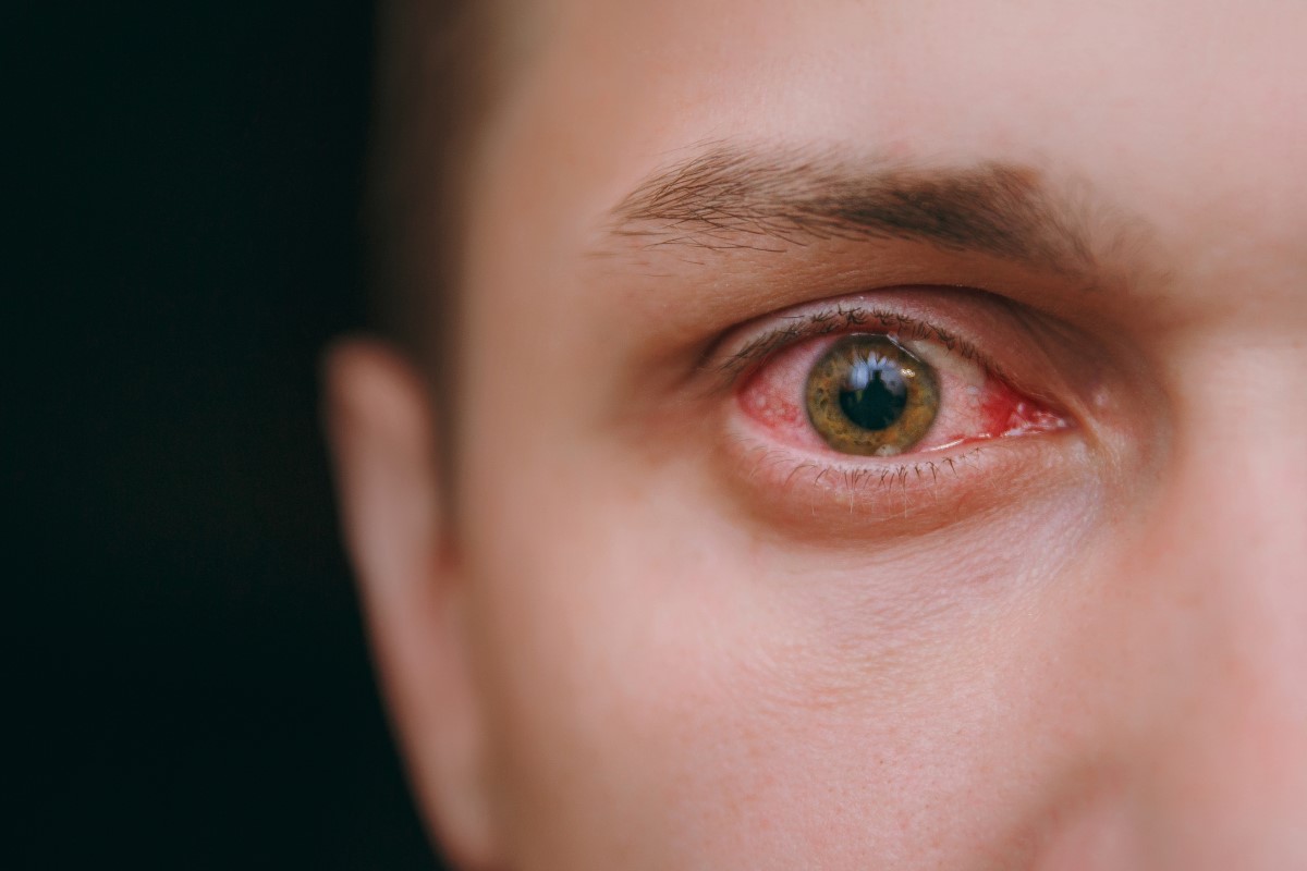 Conjunctival redness: what causes it (+ symptoms) - symptom ...